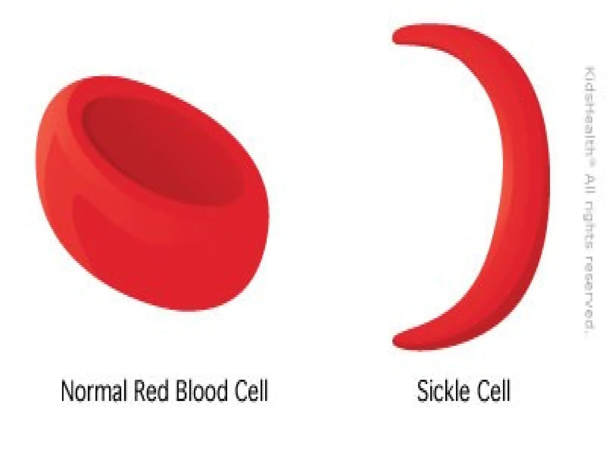 Sickle Cell Disease(anemia classification).pptx