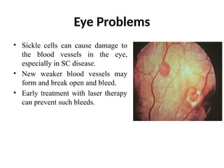 Sickle cell diseaseODAFDKLSFKLDSAJFKL;DSAJFKLSDJFKL;DSJFKLSDJFSAK | PPTX