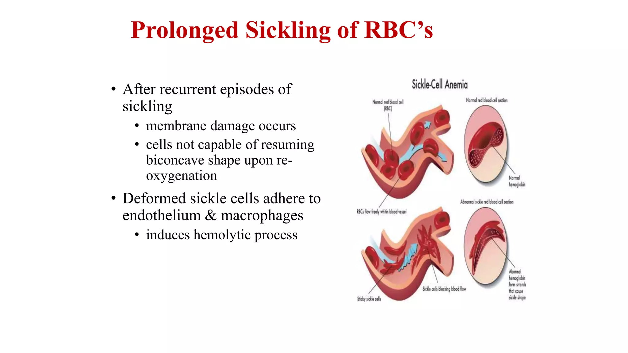 Sickle Cell Disease - Obuasi.pptx