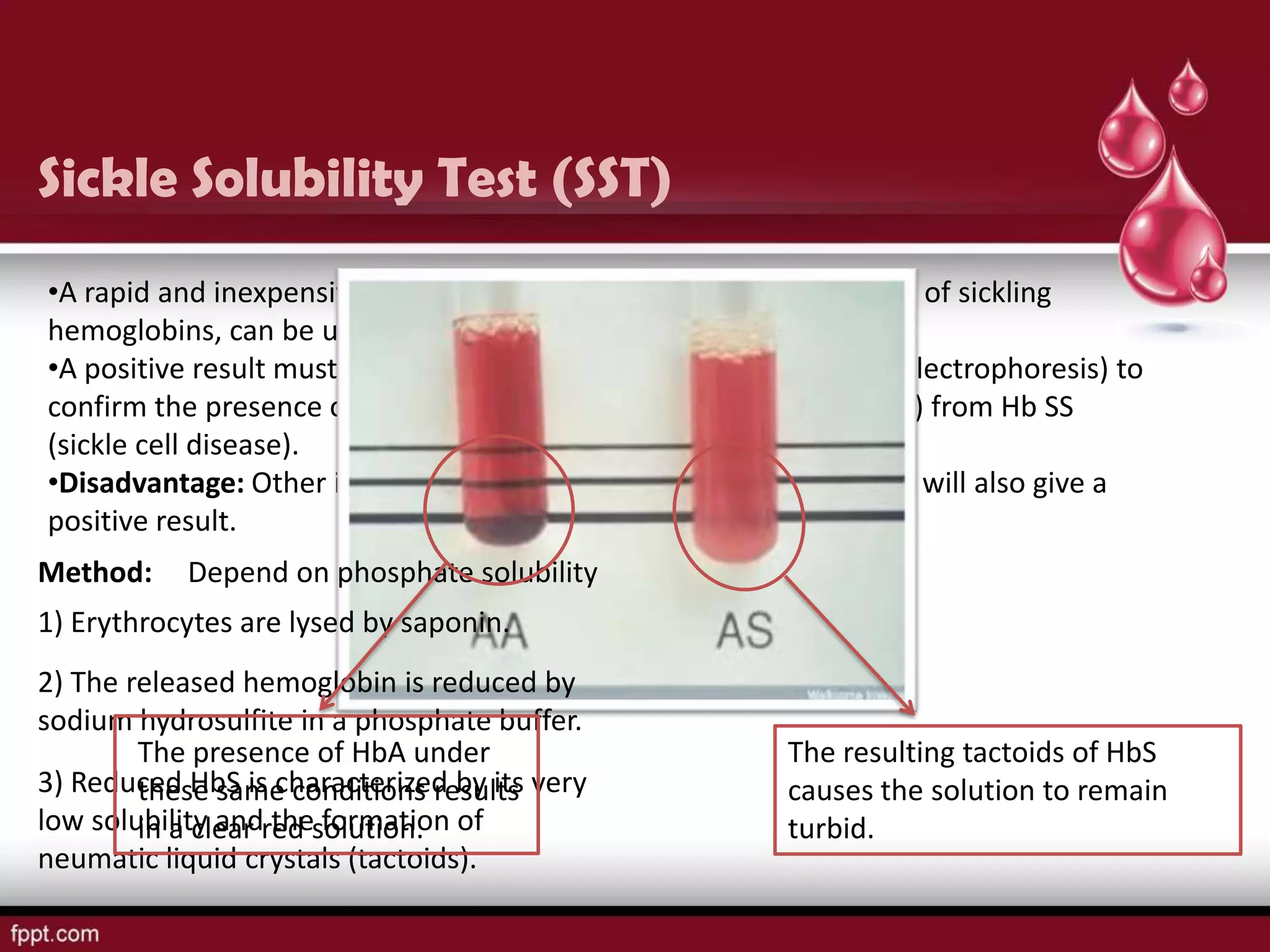 Sickle cell disease | PPTX