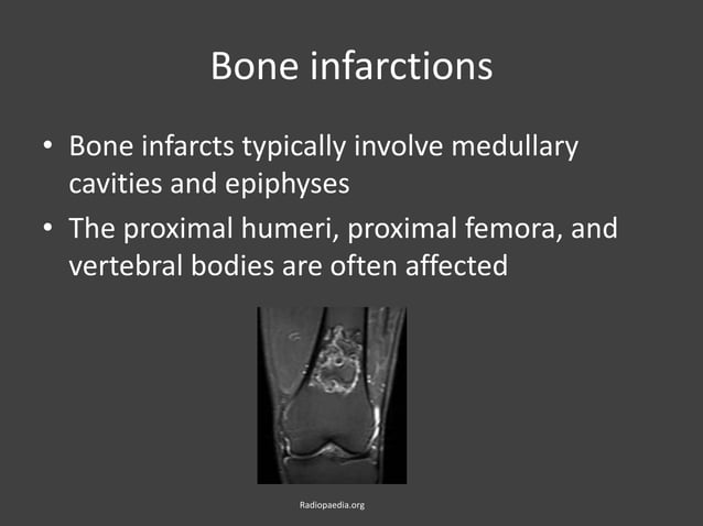 Sickle cell disease (bone changes)_Torfs | PPTX