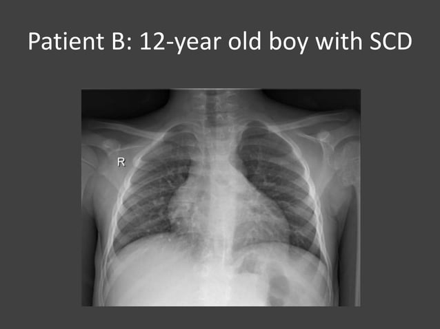 Sickle cell disease (bone changes)_Torfs | PPTX