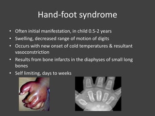 Sickle Cell Anemia Hand Foot Syndrome
