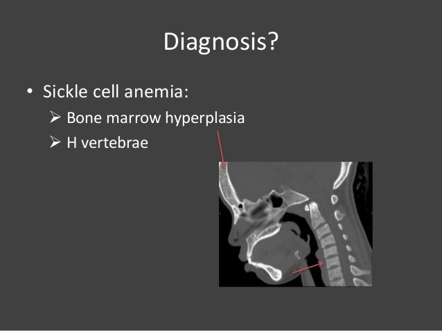 Sickle cell disease (bone changes)_Torfs