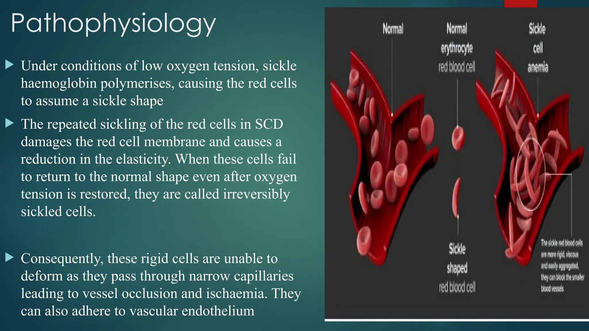 Sickle cell disease in children and management.pptx