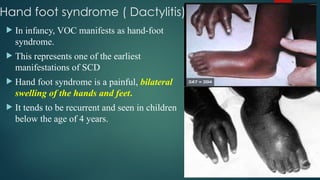 Sickle cell disease in children and management.pptx