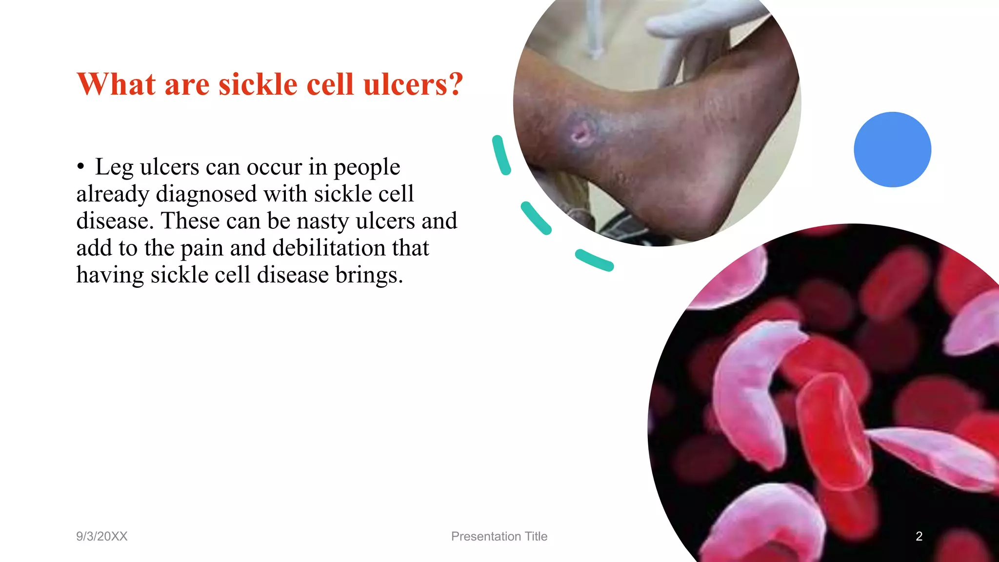 sickle cell leg ulcer.pptx