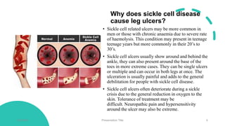 sickle cell leg ulcer.pptx