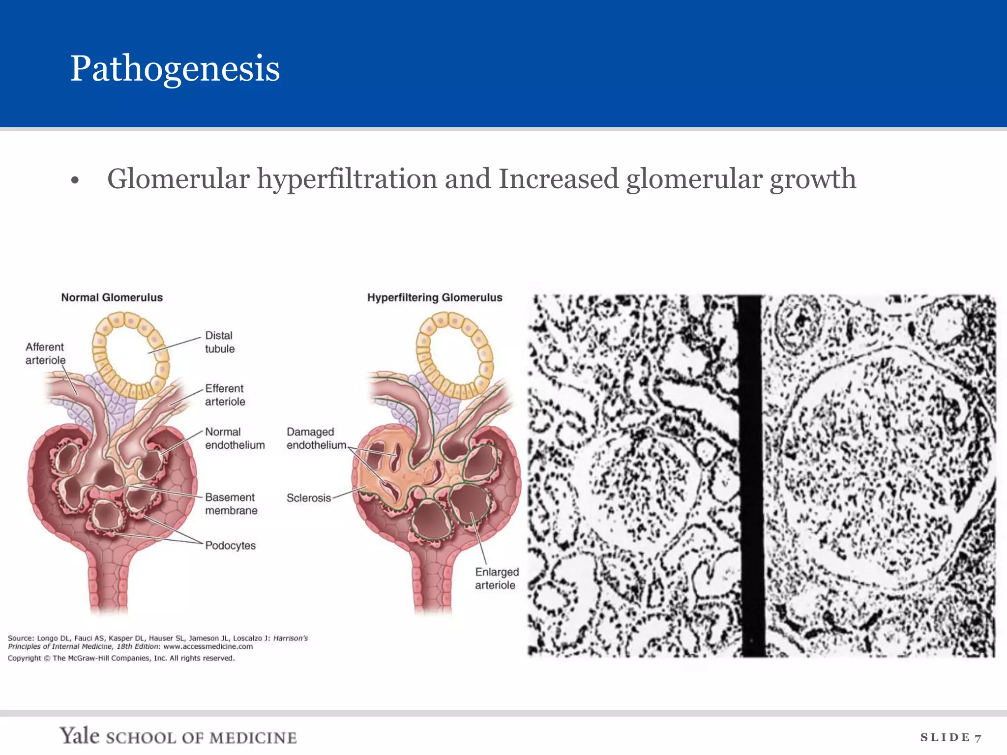 Sickle Cell Nephropathy.pptx