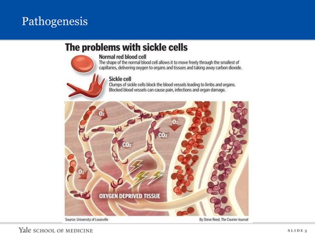 Sickle Cell Nephropathy.pptx | Blood Disorders | Diseases and Conditions