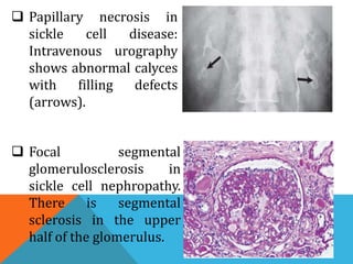 Sickle cell nephropathy SCN | PPTX