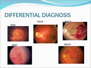 treatment of SICKLE CELL RETINOPATHY.NYOD.ppt