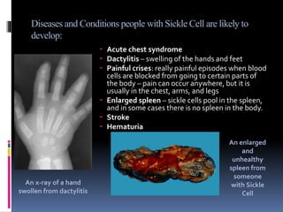 Sickle_Cell_Ulcers.pptx