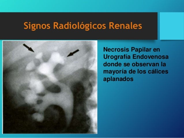 Sicklemia y talasemias en imagenología