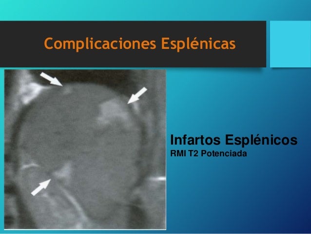 Sicklemia y talasemias en imagenología