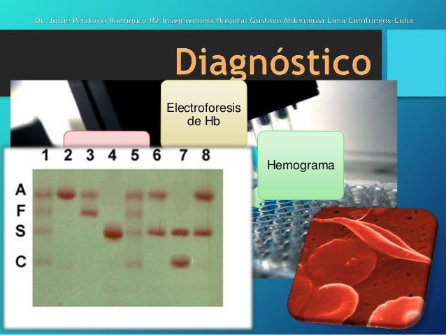 Sicklemia y talasemias en imagenología