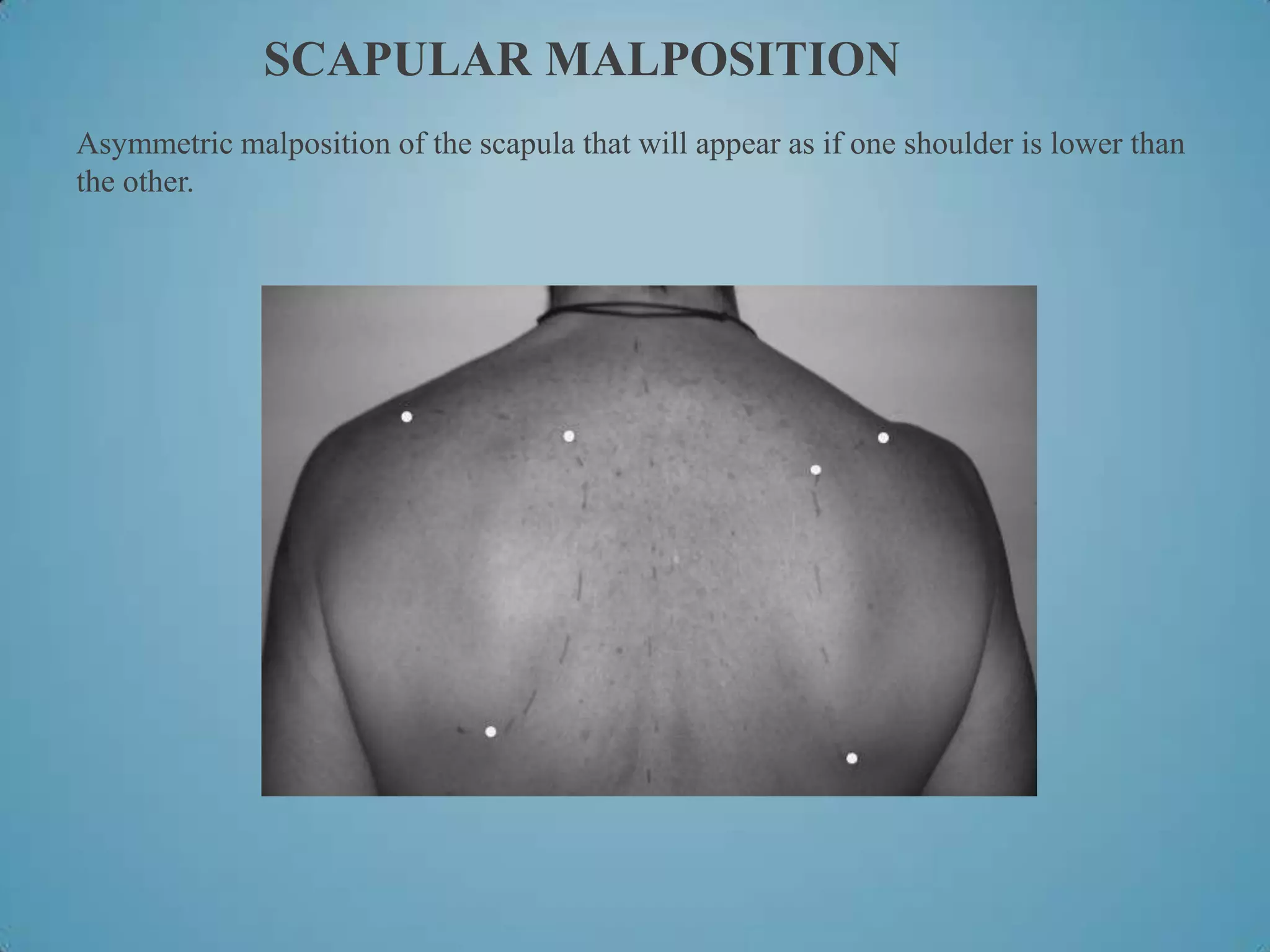 S.I.C.K. Scapula with Clavicle Fractures Case Study Presentation (2013 ...
