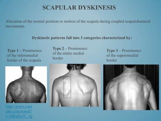S.I.C.K. Scapula with Clavicle Fractures Case Study Presentation (2013 ...