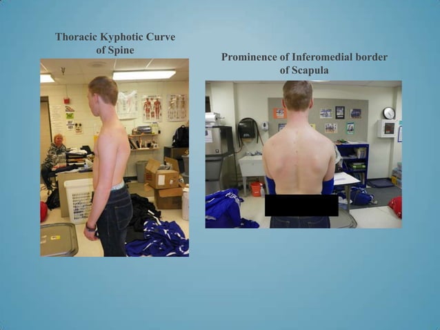 S.I.C.K. Scapula with Clavicle Fractures Case Study Presentation (2013 ...