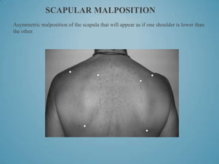 S.I.C.K. Scapula with Clavicle Fractures Case Study Presentation (2013 ...