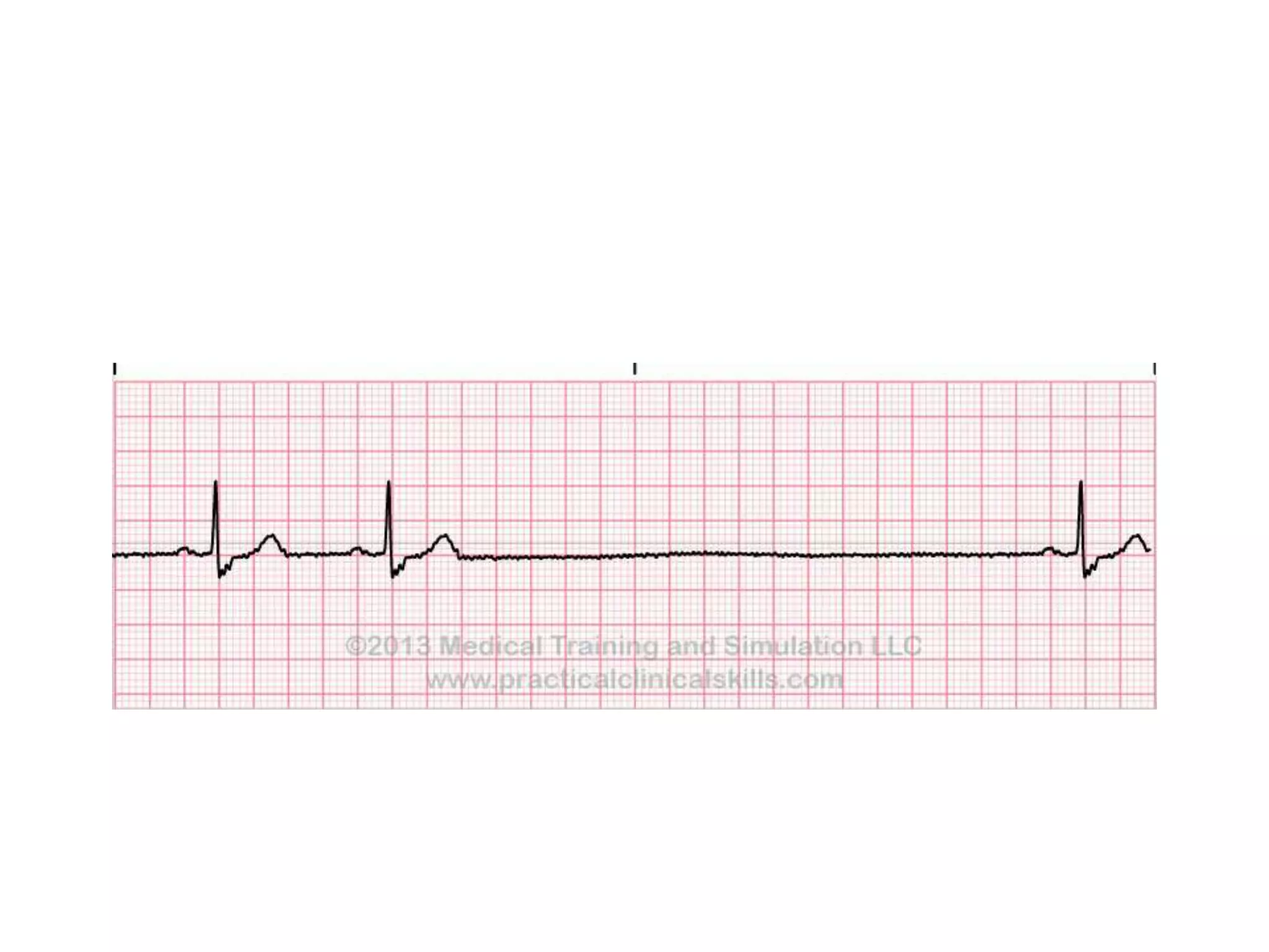 Sick sinus syndrome | PPTX