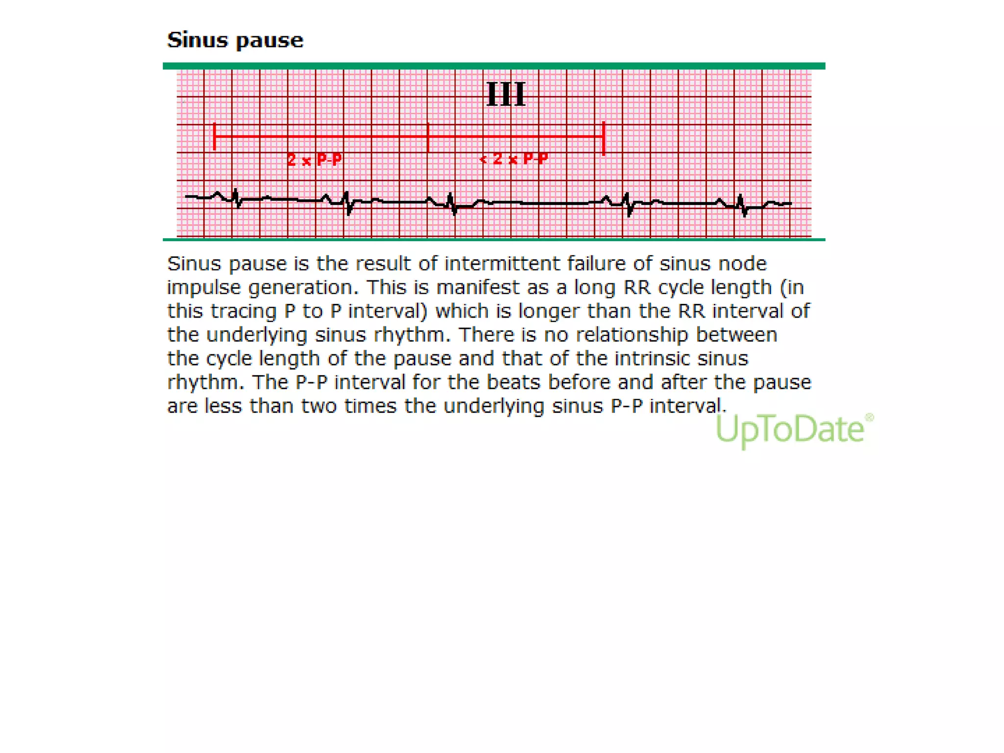 Sick sinus syndrome | PPTX