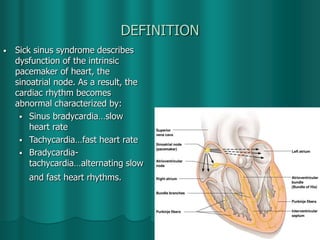 Sick sinus syndrome and its types with causes 2 | PPT