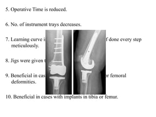 Patient Specific Instrumentation in TKR | PPTX