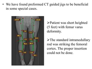 Patient Specific Instrumentation in TKR | PPTX