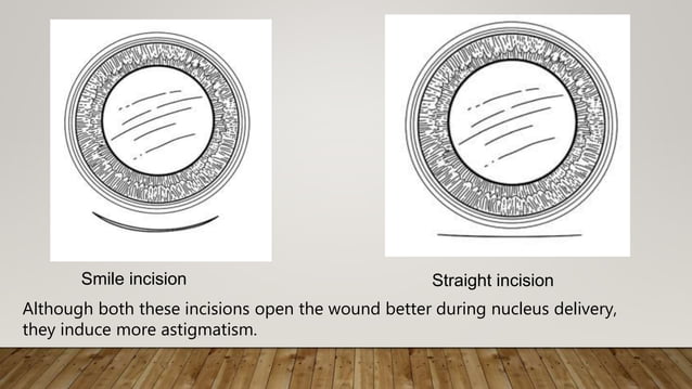 Sics steps | PPTX | Eye and Vision Conditions | Diseases and Conditions