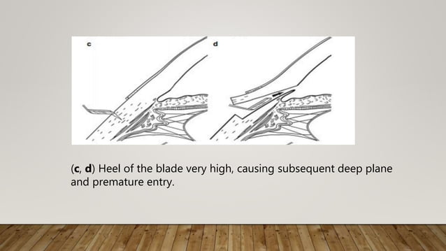Sics steps | PPTX | Eye and Vision Conditions | Diseases and Conditions