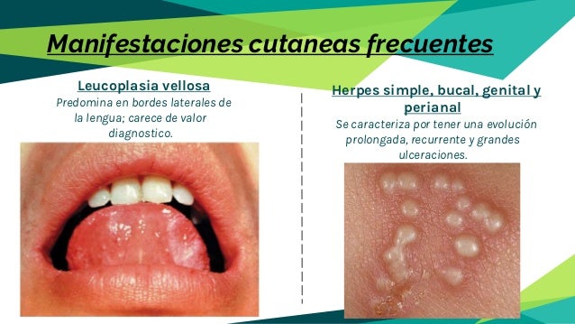VIH en dermatologia