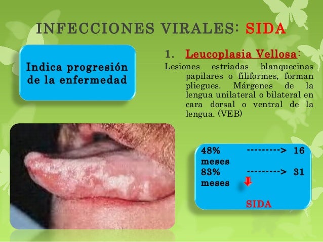 Manifestaciones del Sida en Cavidad Oral