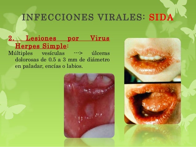 Manifestaciones del Sida en Cavidad Oral