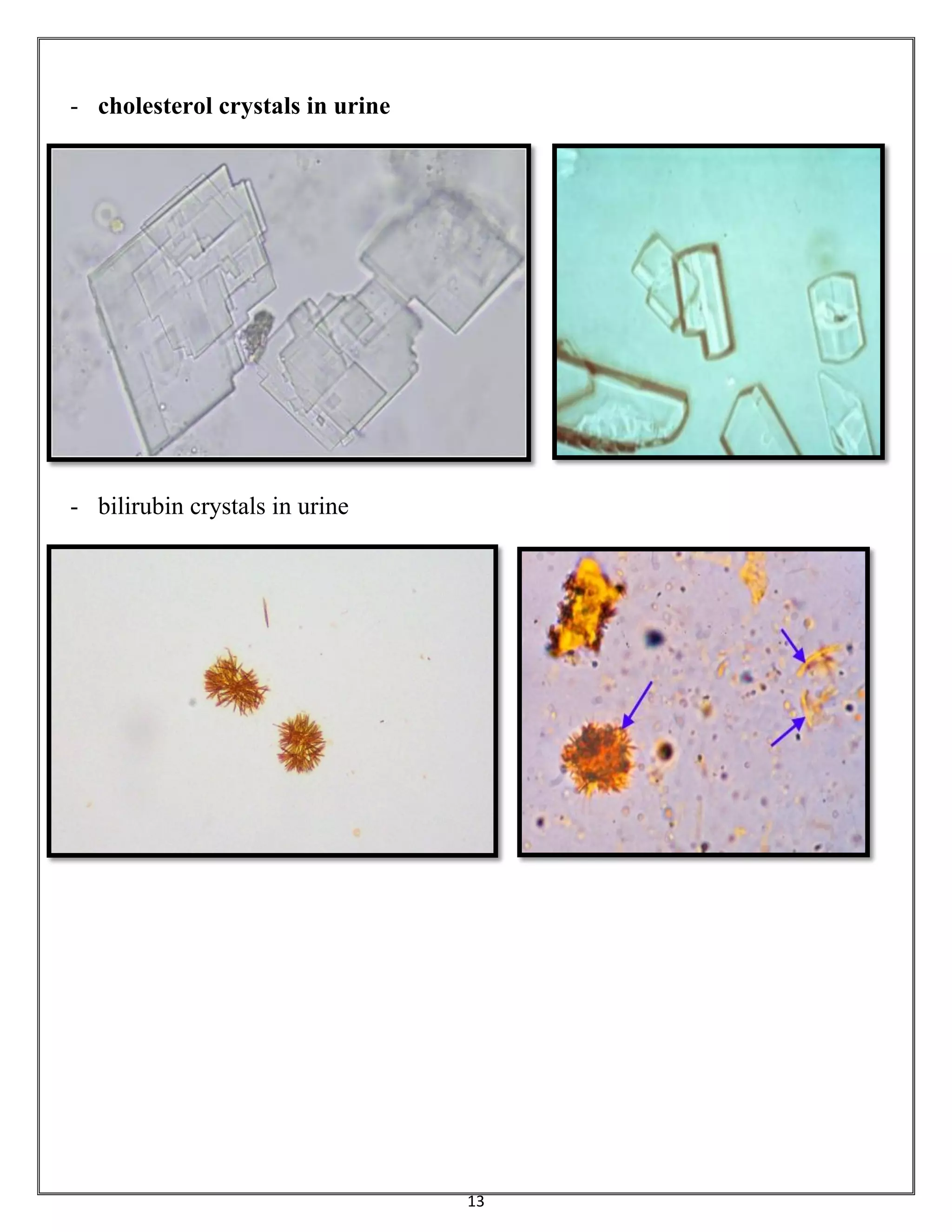 Bilirubin Crystal In Urine