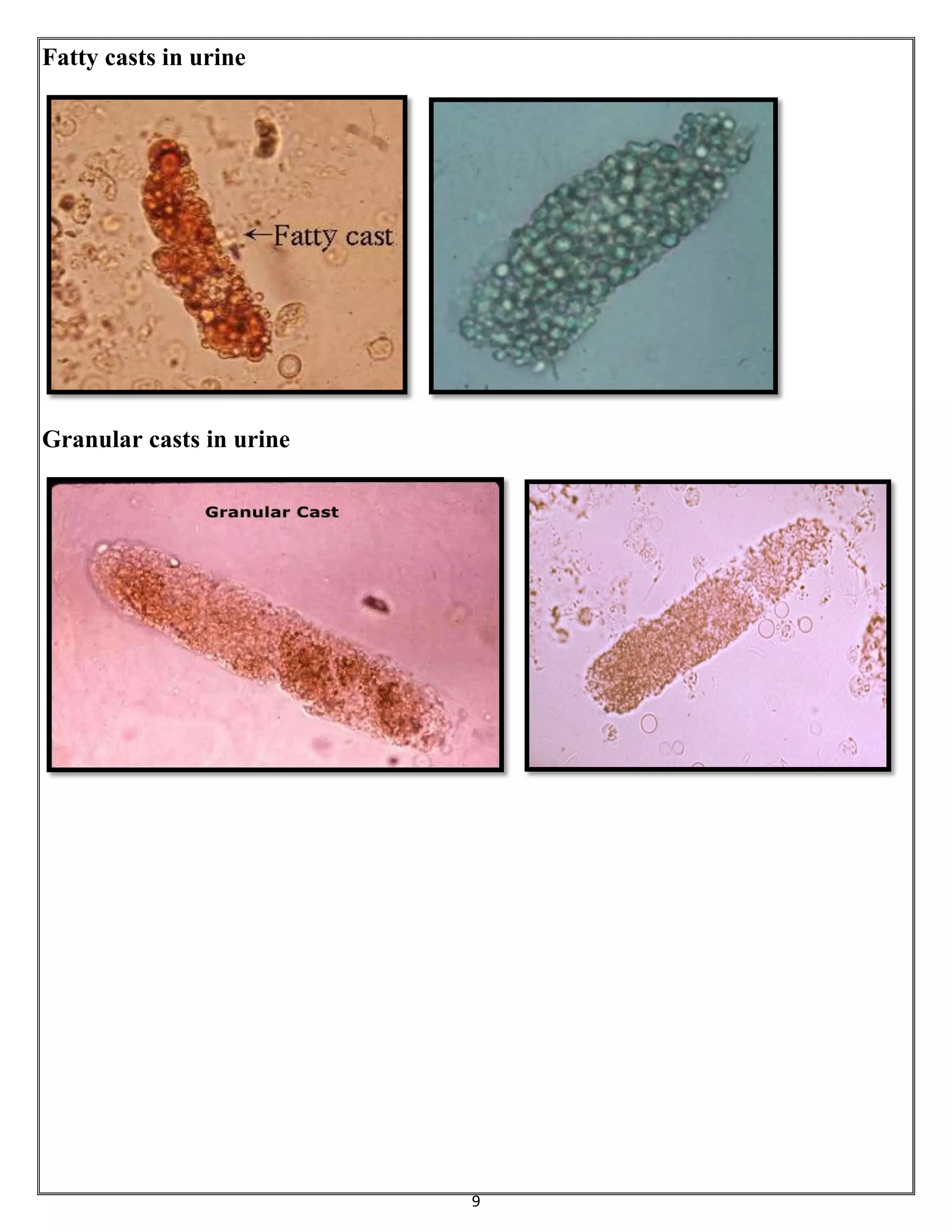 Fatty Casts In Urine