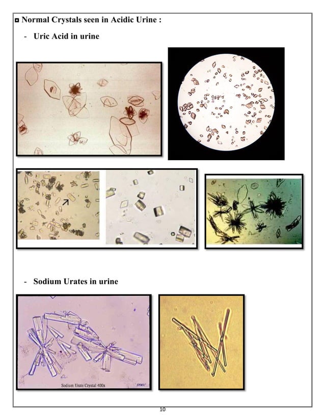 Urine analysis & Hematology Slides | PDF | Blood Disorders | Diseases ...