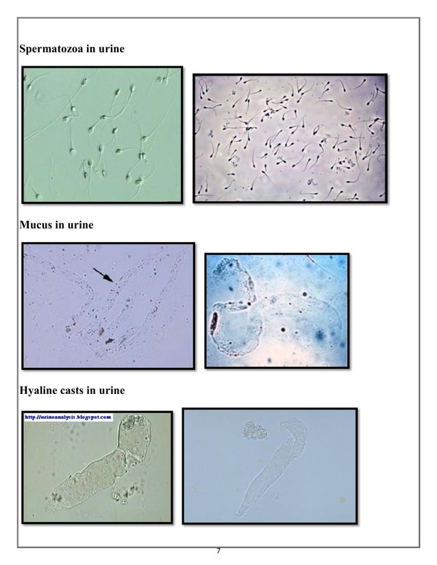 Urine analysis & Hematology Slides | PDF | Blood Disorders | Diseases ...