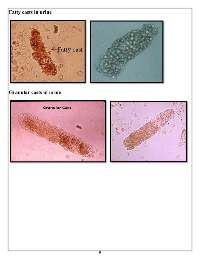 Urine analysis & Hematology Slides | PDF | Blood Disorders | Diseases ...