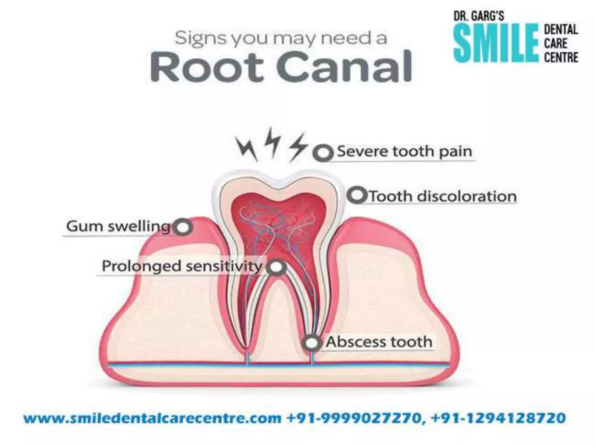 What Are The Side Effect And Dangers of Root Canal Treatment? | PPTX