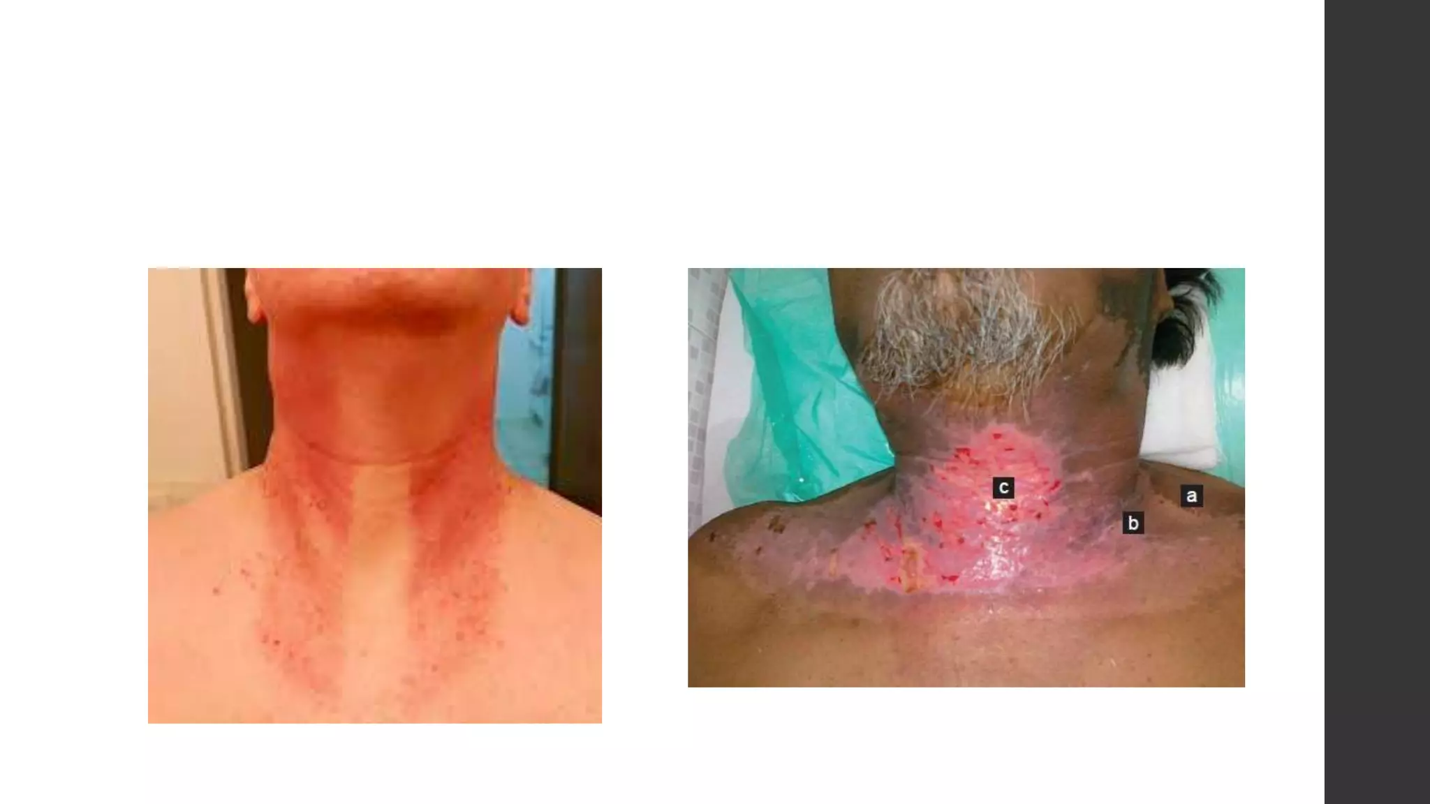 Side effects of radiation in head and neck cancer | PPTX