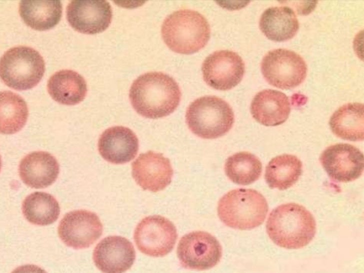 Anemia sideroblastica
