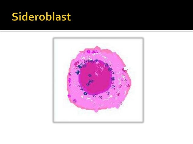 Sideroblastic anemia