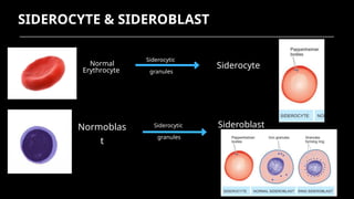 Sideroblastic anemia (kartik chande 24044).pptx