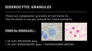Sideroblastic anemia (kartik chande 24044).pptx