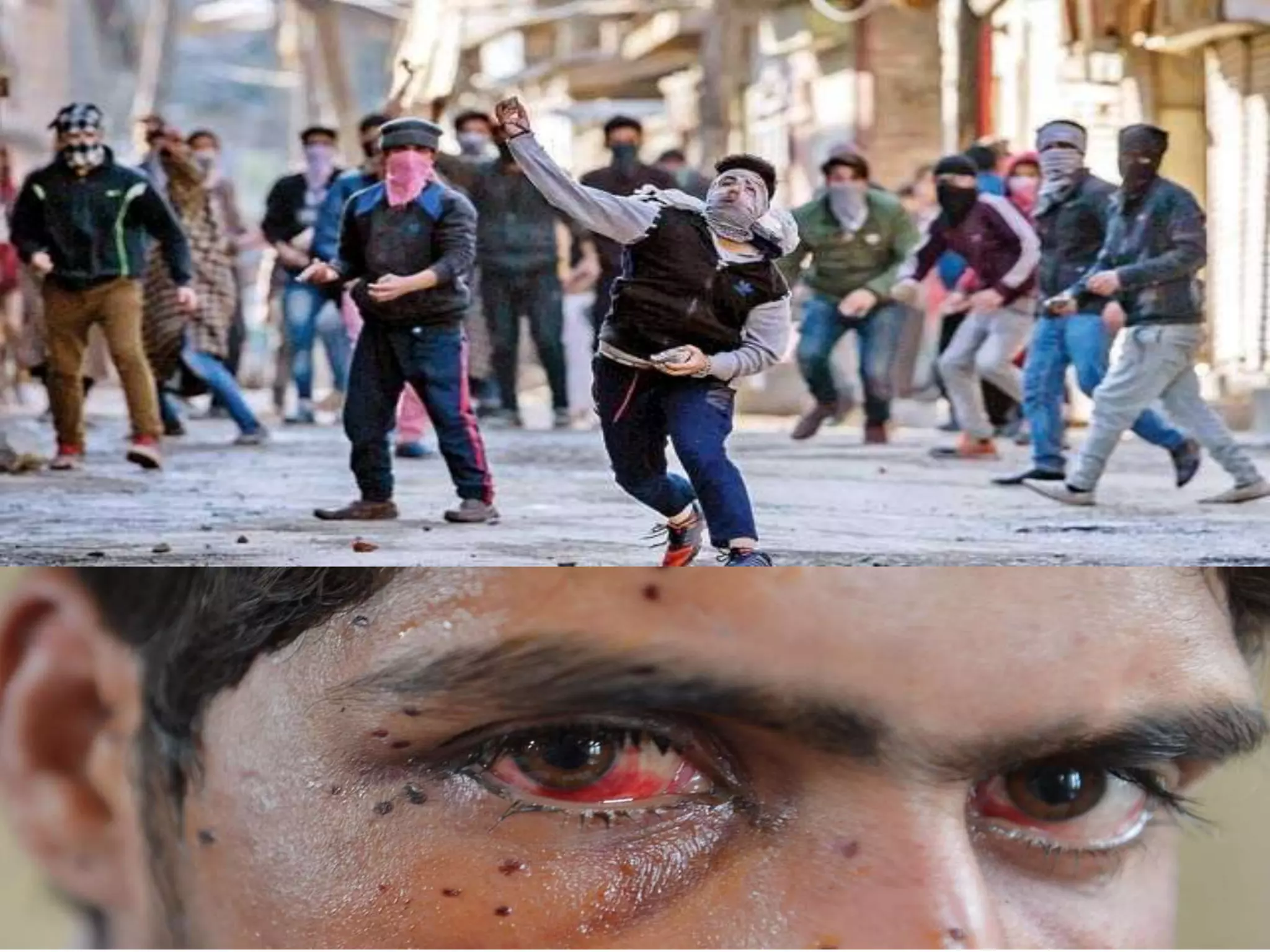 Siderosis &chalcosis & IOFB | PPTX