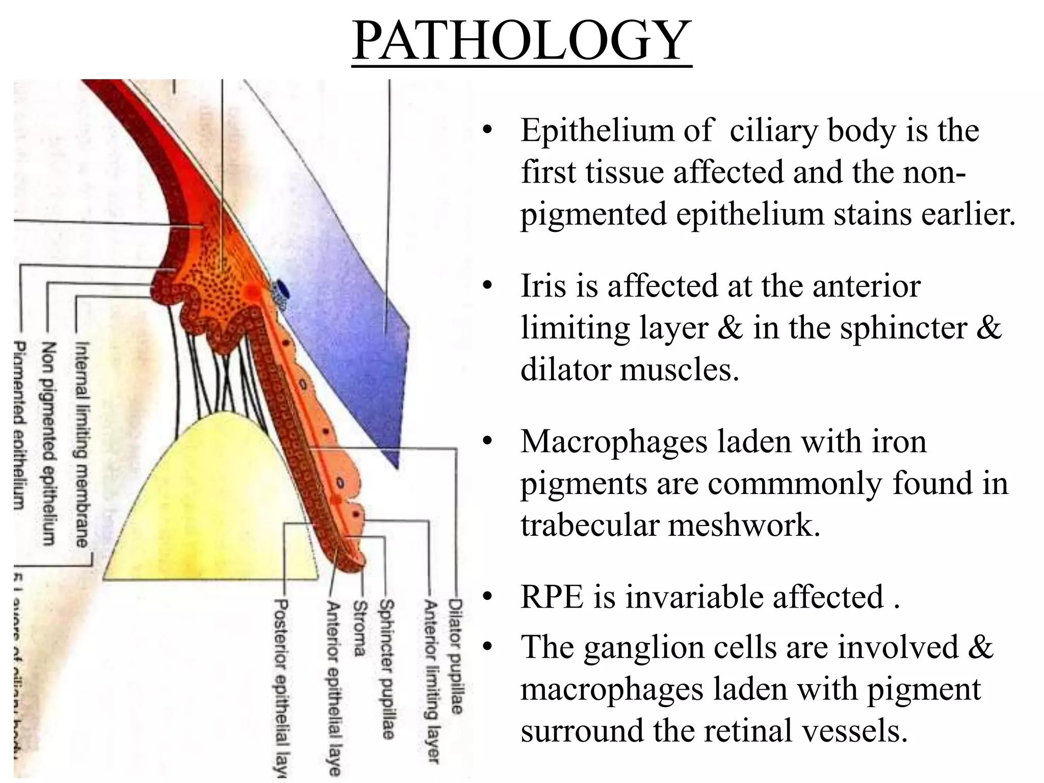 Siderosis &chalcosis & IOFB | PPTX