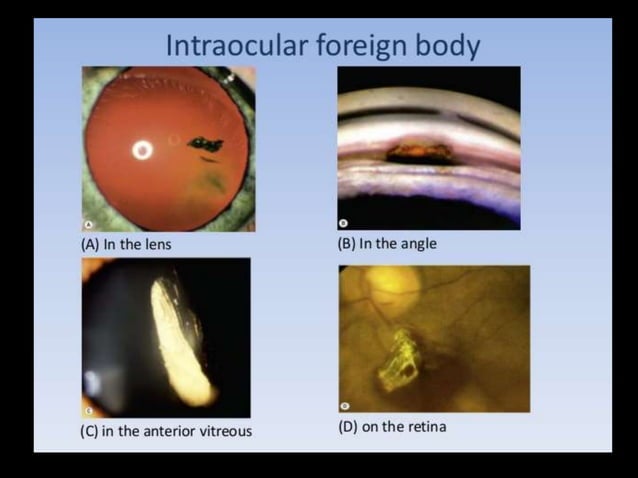 Siderosis &chalcosis & IOFB | PPTX | Eye and Vision Conditions ...