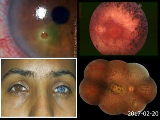 Siderosis &chalcosis & IOFB | PPTX