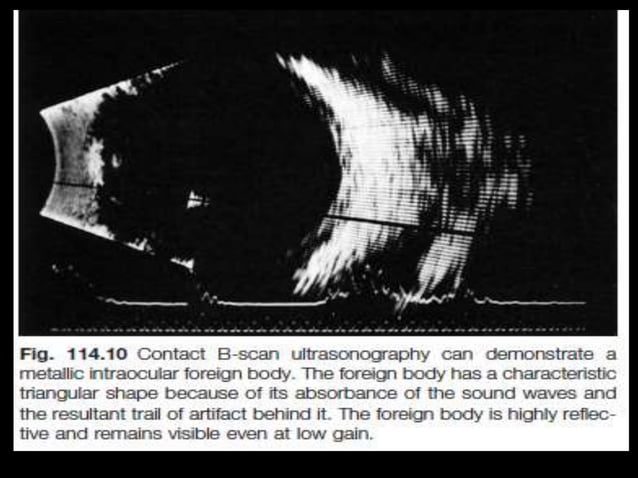 Siderosis &chalcosis & IOFB | PPTX | Eye and Vision Conditions ...